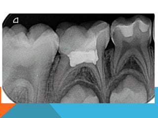 Endocrown | PPTX