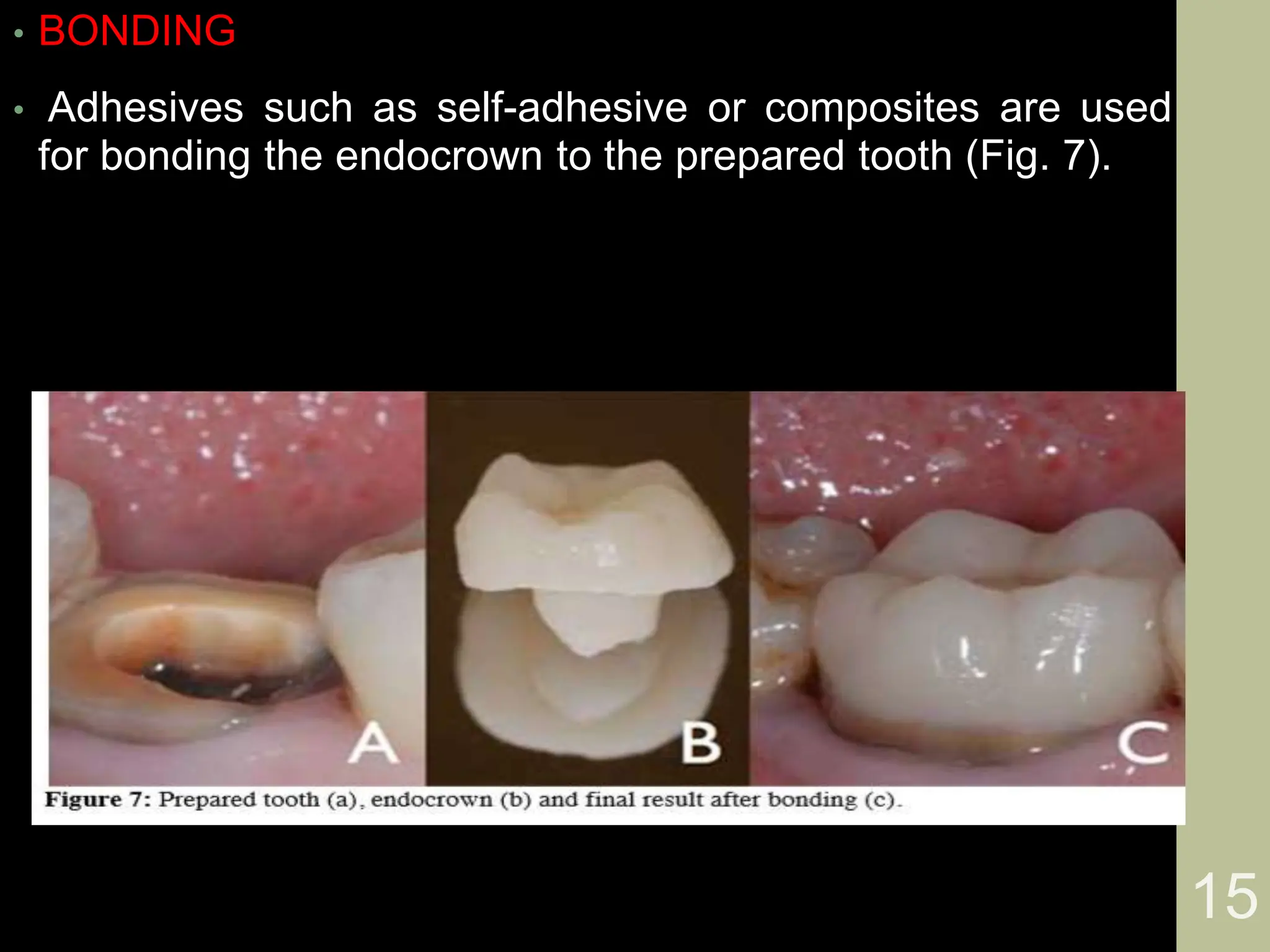 endocrown.pptx............................. | PPTX