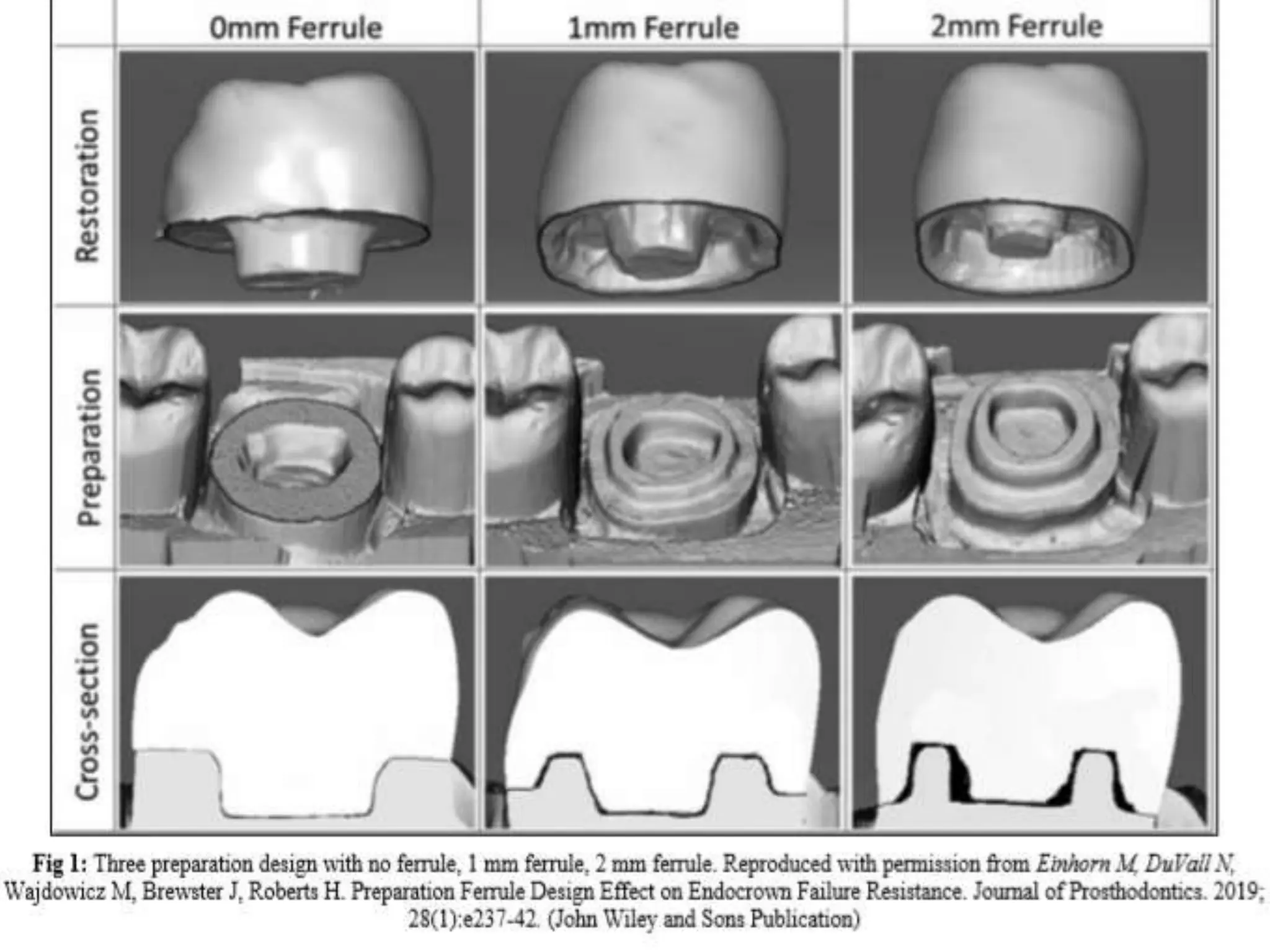 endocrown.pptx............................. | PPTX