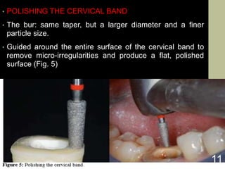 endocrown.pptx............................. | PPTX