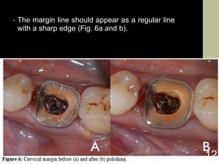 endocrown.pptx............................. | PPTX