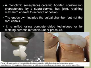 endocrown.pptx............................. | PPTX