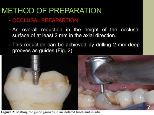 endocrown.pptx............................. | PPTX