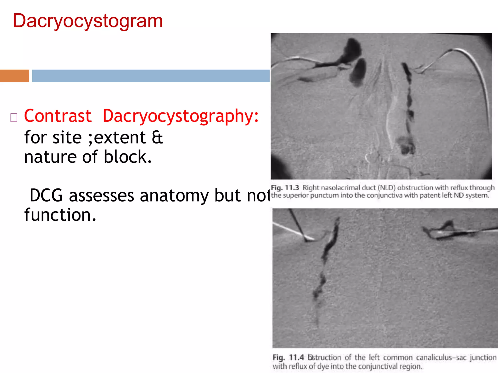 Endoscopic DCR | PPTX
