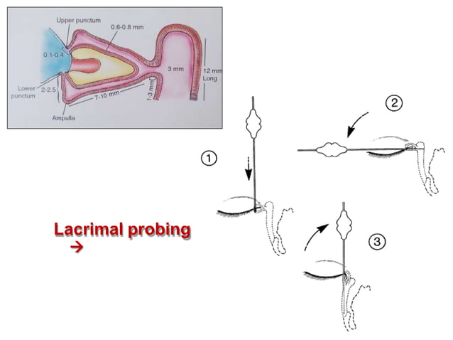 Endoscopic Dcr Ppt