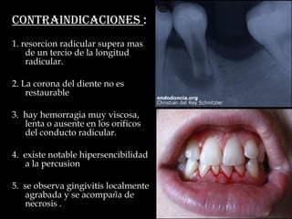 Endodoncia pediatrica | PPT