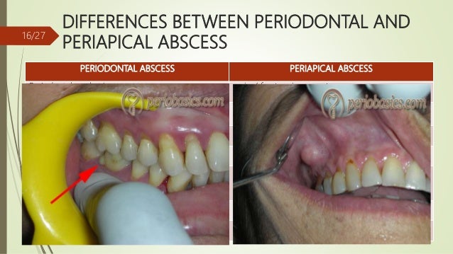 Endodontic periodontal interactions