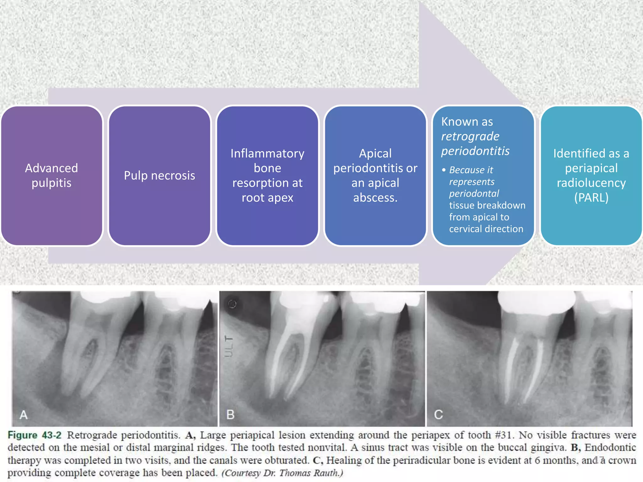 Endodontic periodontic interrelationship | PPTX