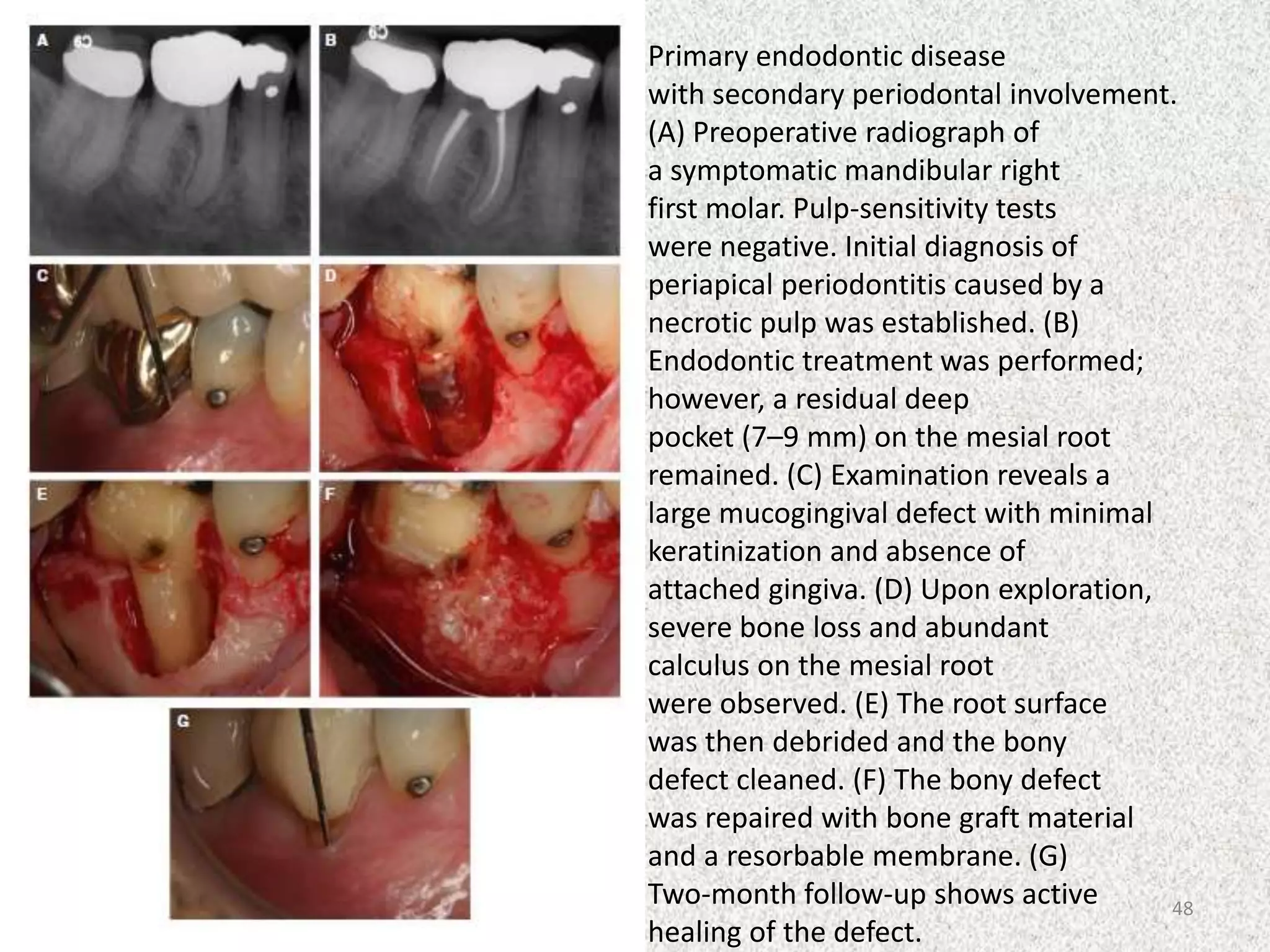 Endodontic periodontic interrelationship | PPTX