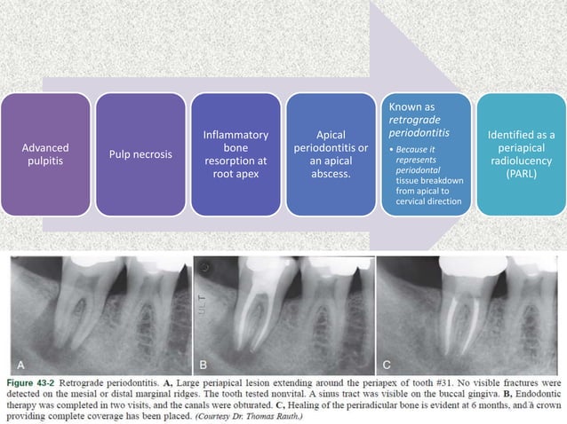 Endodontic periodontic interrelationship | PPTX