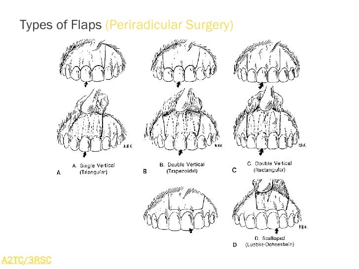 Endodontic Surgery