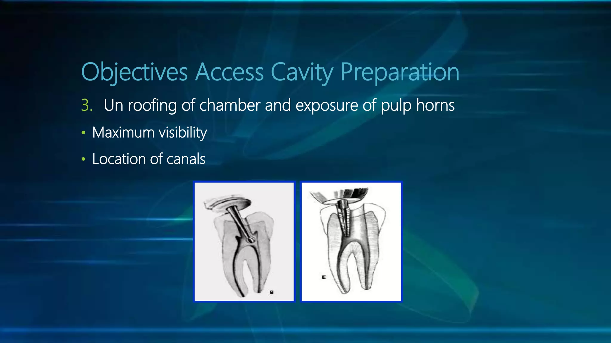 Endodontic Access Cavity Preparation | PPTX