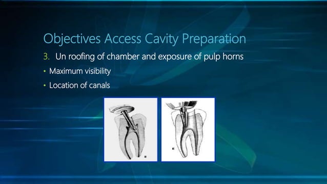 Endodontic Access Cavity Preparation | PPTX