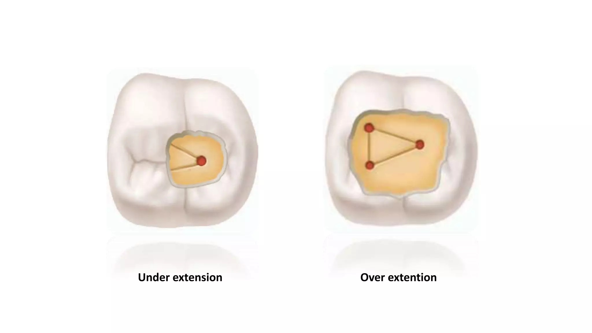 Endodontic Access Cavity.pptx
