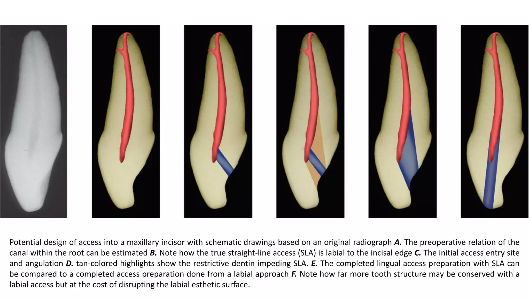 Endodontic Access Cavity.pptx