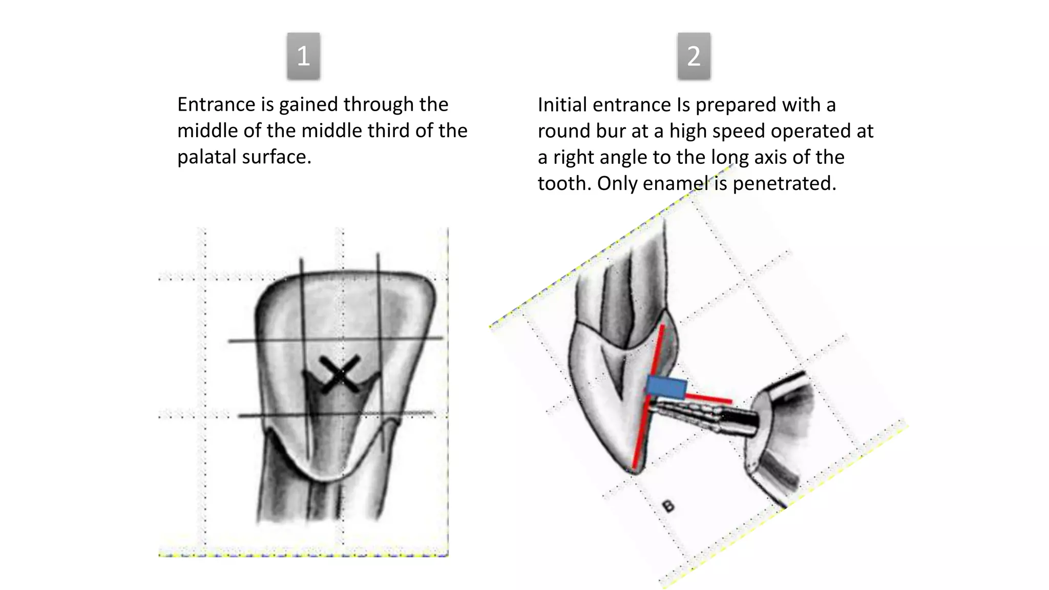 Endodontic Access Cavity.pptx