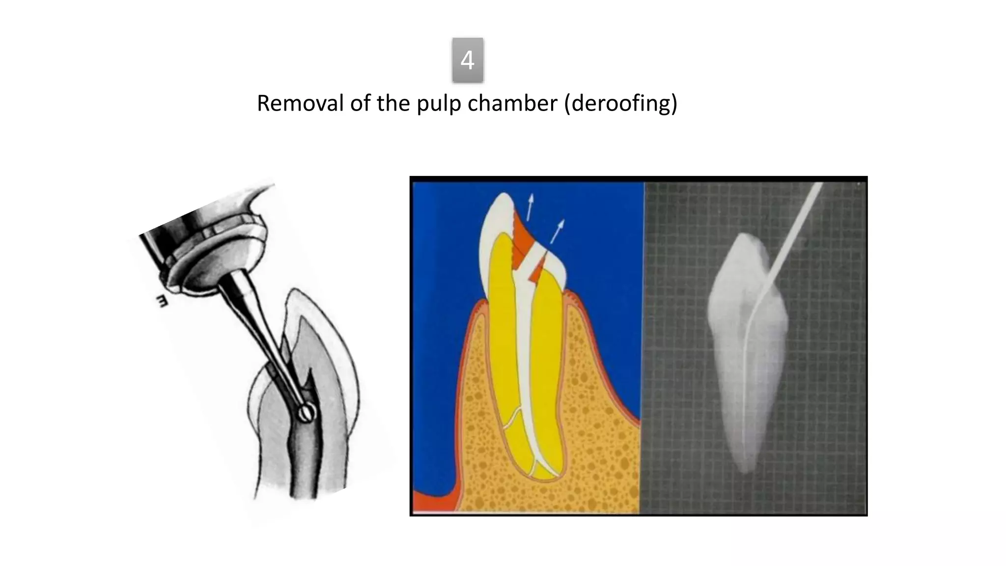 Endodontic Access Cavity.pptx