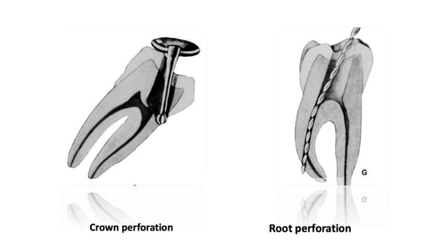 Endodontic Access Cavity.pptx | Dental Health | Diseases and Conditions