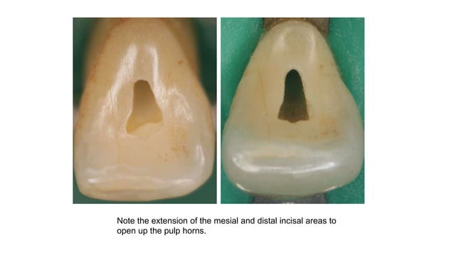 Endodontic Access Cavity.pptx | Dental Health | Diseases and Conditions