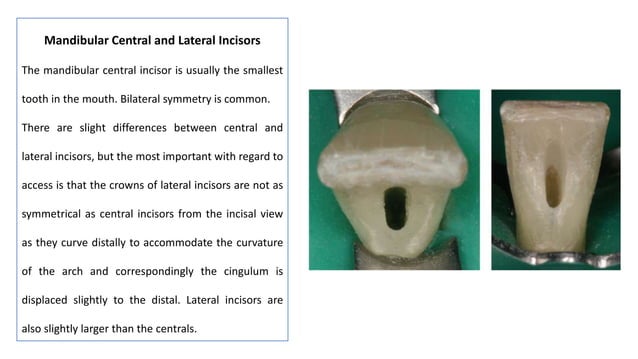 Endodontic Access Cavity.pptx | Dental Health | Diseases and Conditions