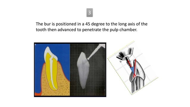 Endodontic Access Cavity.pptx | Dental Health | Diseases and Conditions