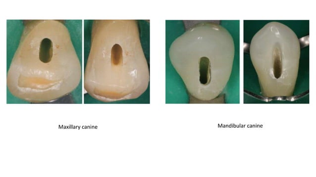 Endodontic Access Cavity.pptx | Dental Health | Diseases and Conditions