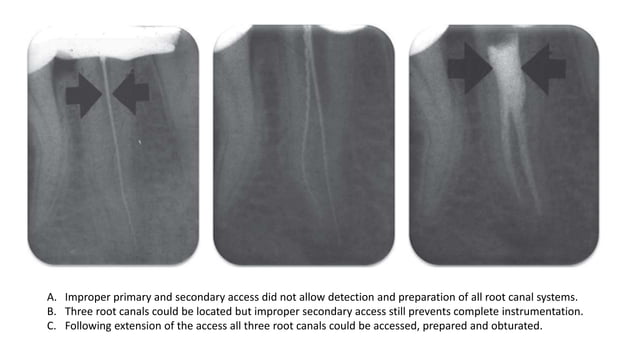 Endodontic Access Cavity.pptx | Dental Health | Diseases and Conditions