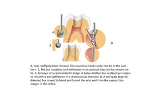 Endodontic Access Cavity.pptx