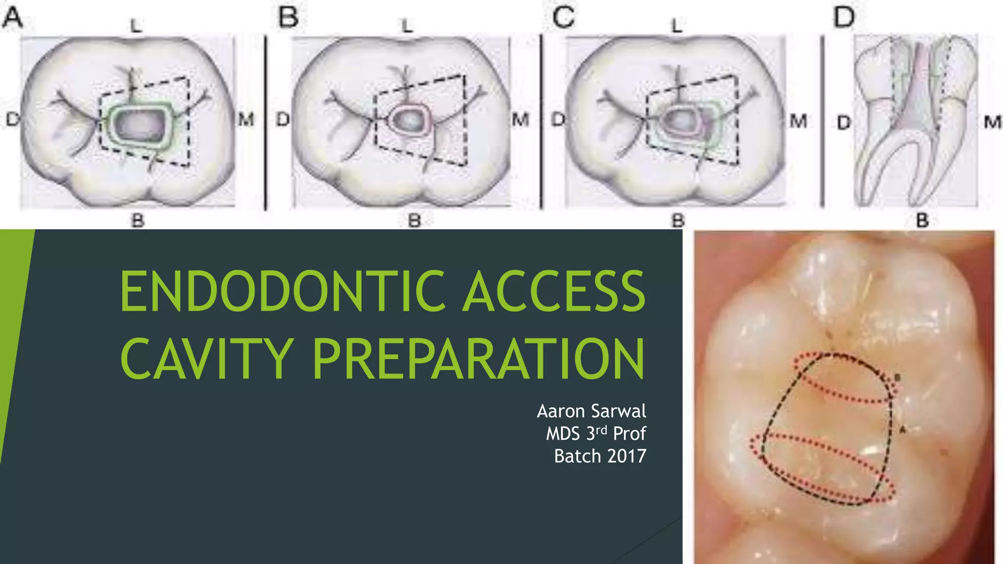 Endodontic Access Cavity Preparation | PPTX