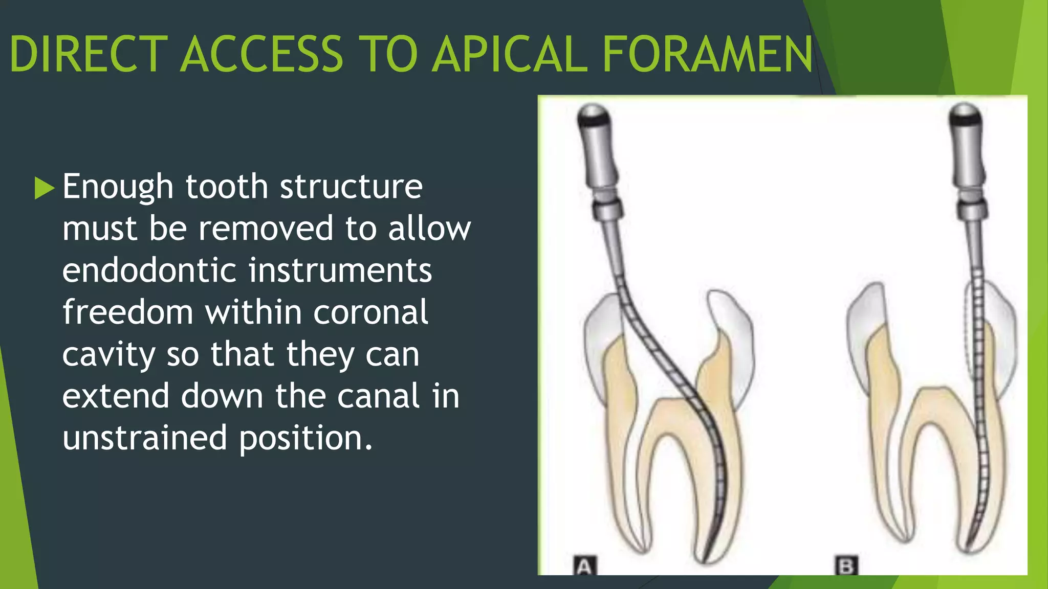 Endodontic Access Cavity Preparation | PPTX