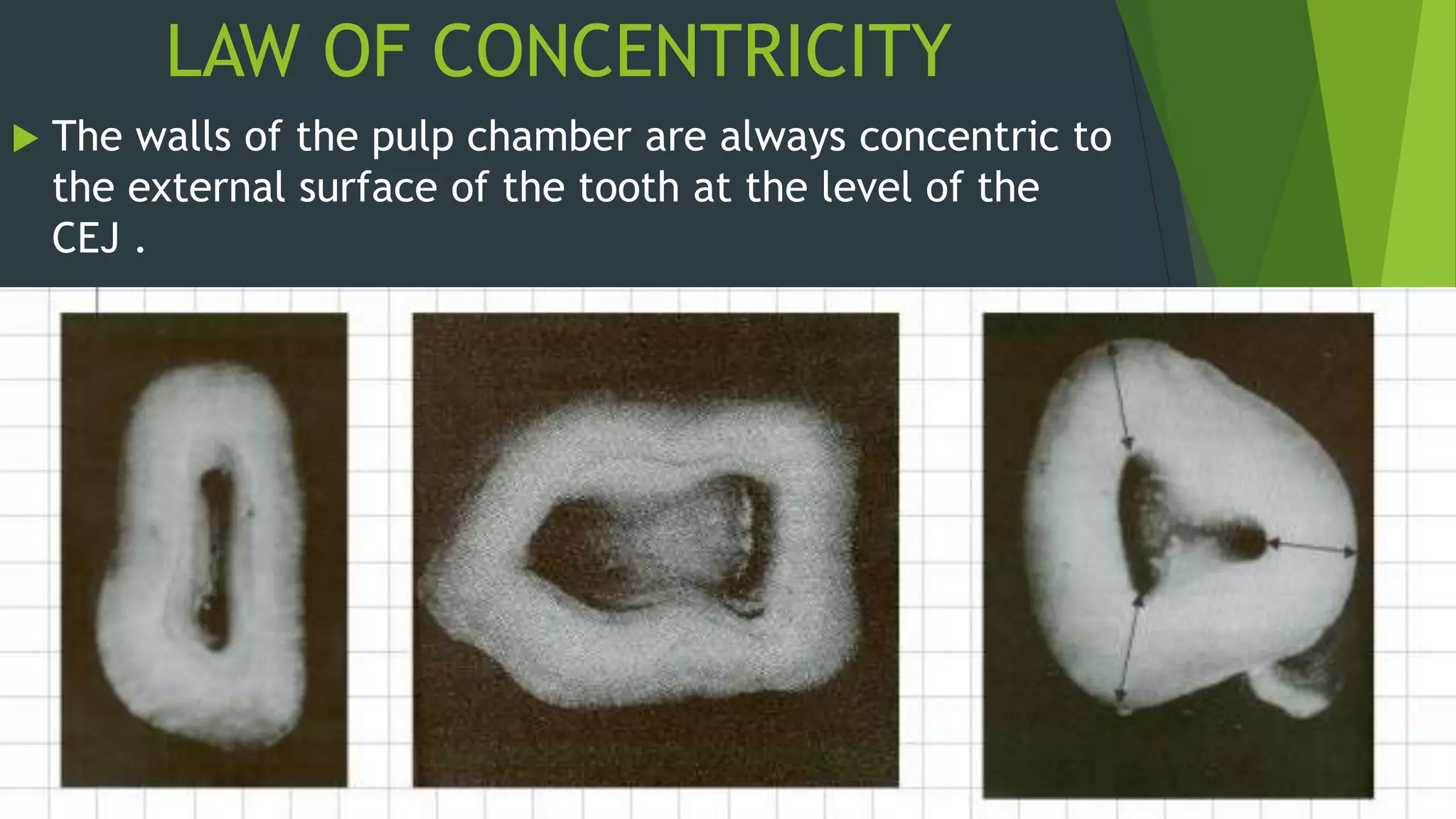 Endodontic Access Cavity Preparation | PPTX