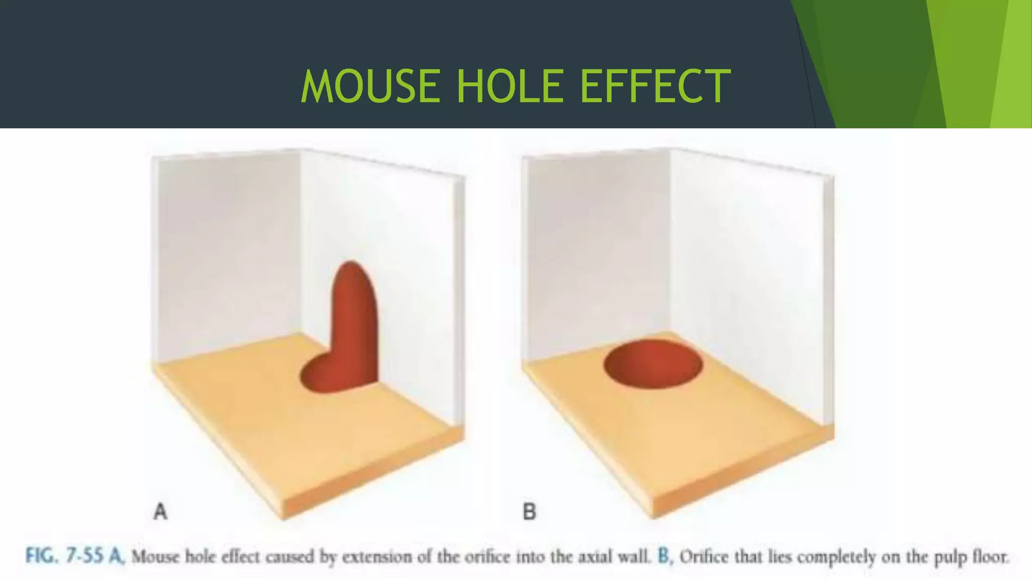 Endodontic Access Cavity Preparation | PPTX