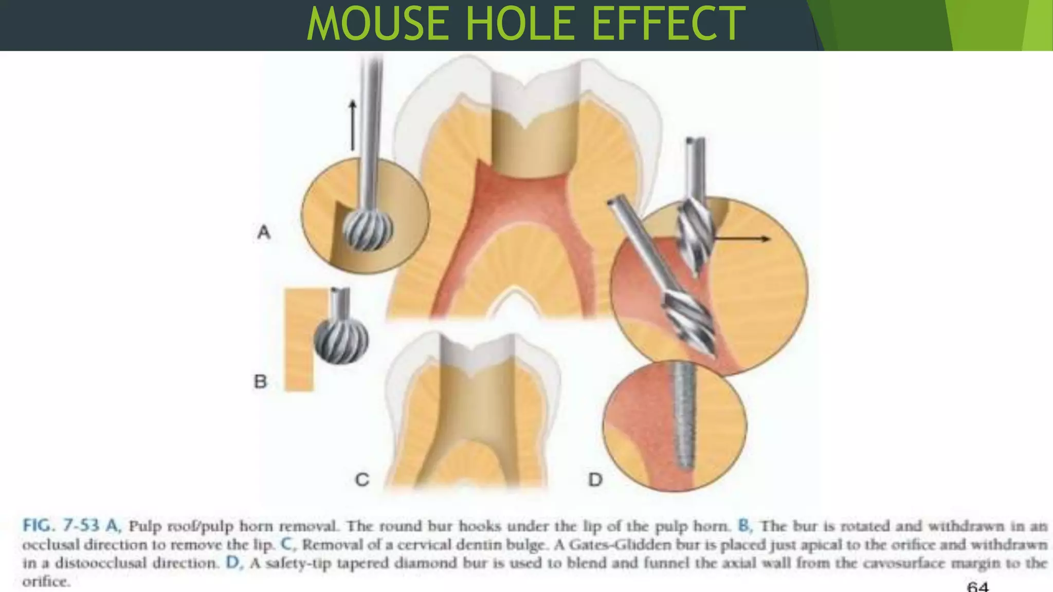 Endodontic Access Cavity Preparation | PPTX