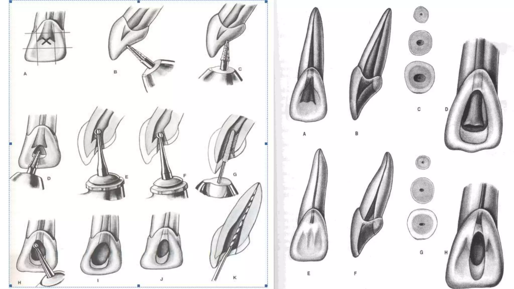 Endodontic Access Cavity Preparation | PPTX