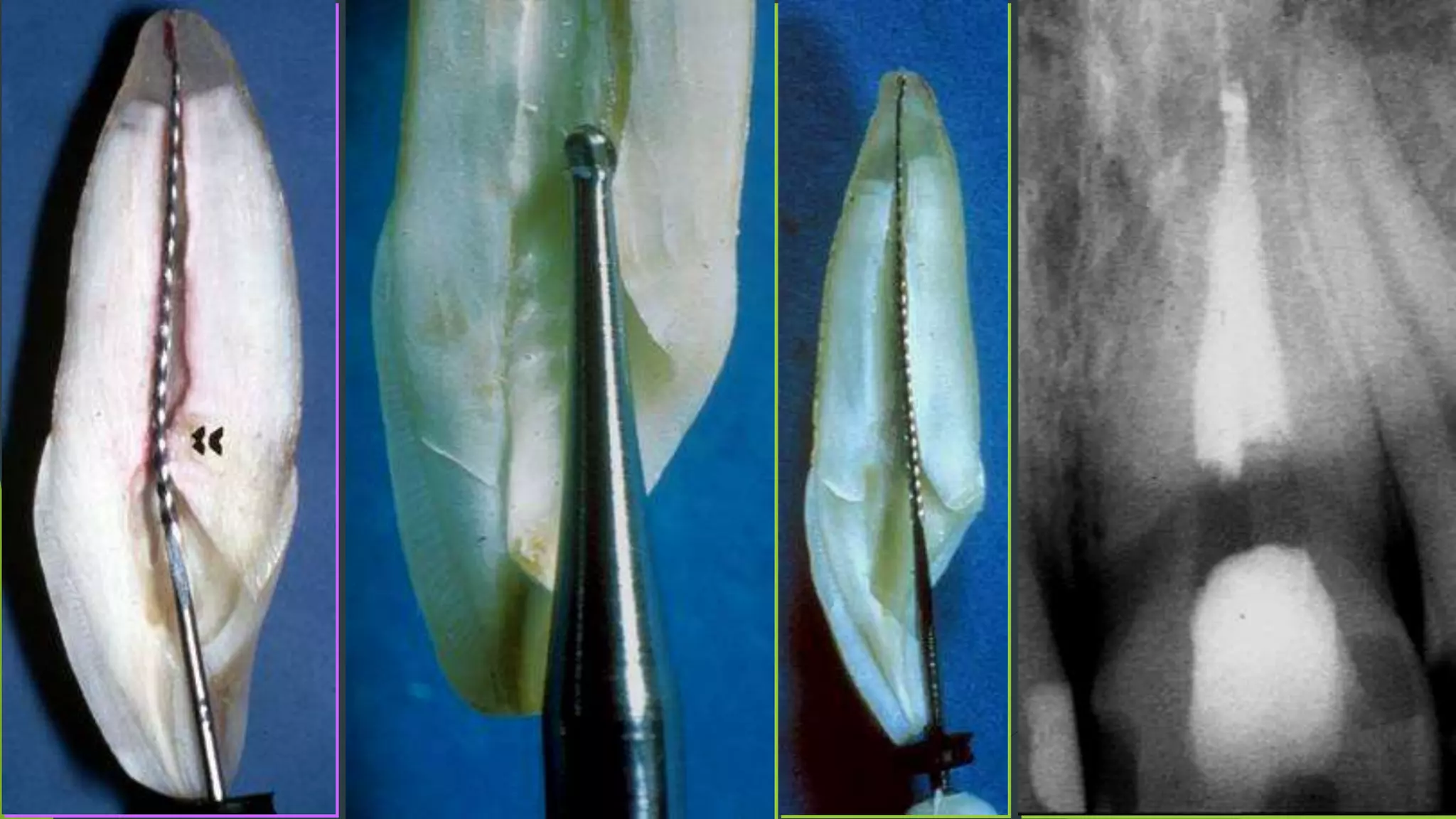 Endodontic Access Cavity Preparation | PPTX