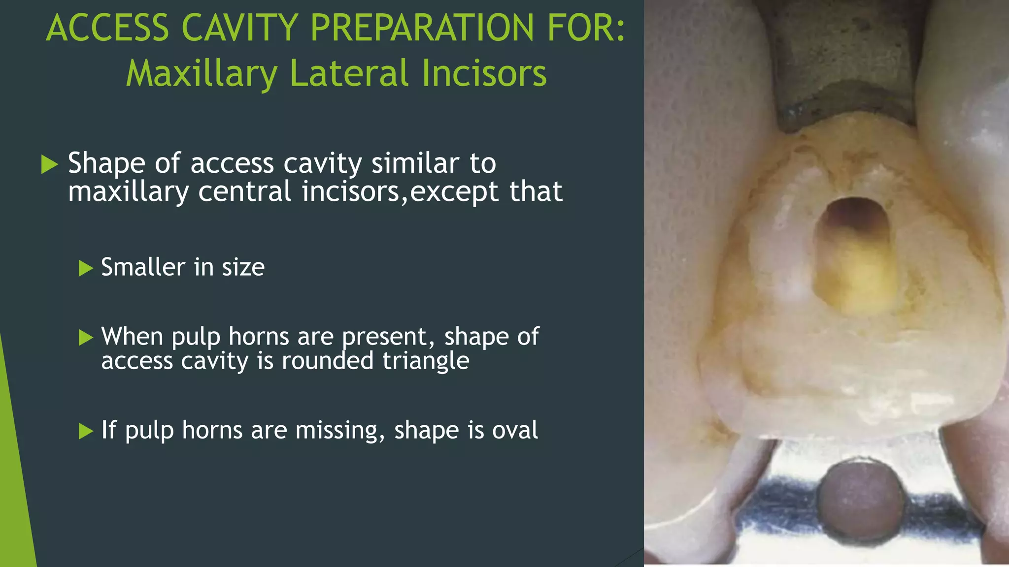 Endodontic Access Cavity Preparation | PPTX