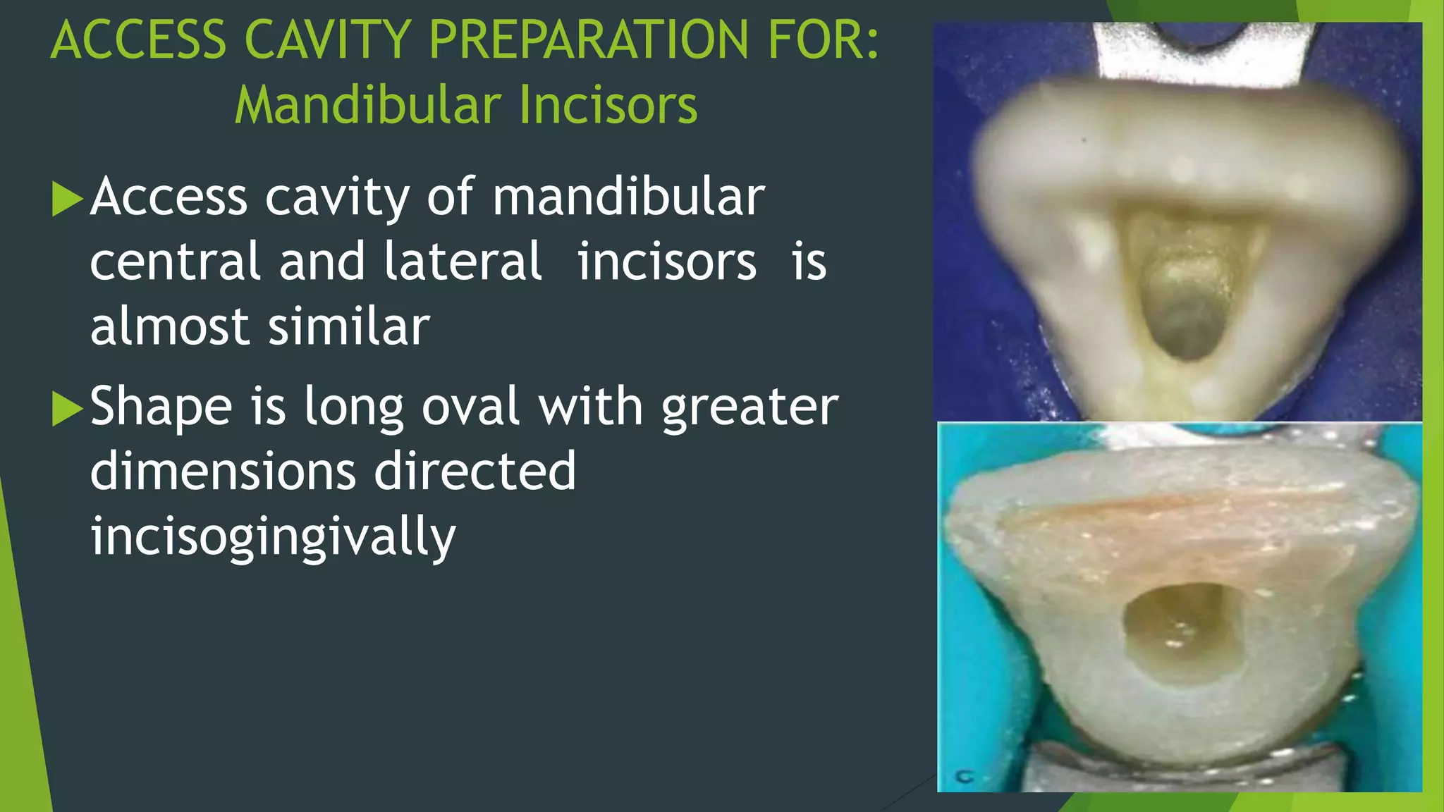 Endodontic Access Cavity Preparation | PPTX