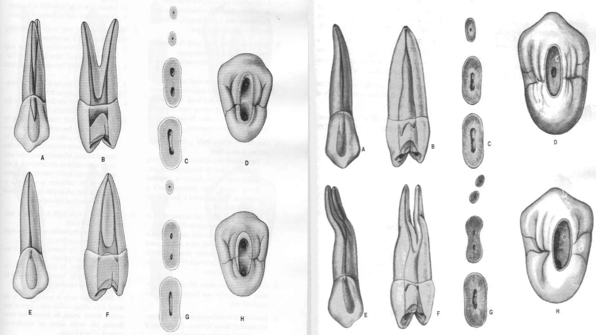 Endodontic Access Cavity Preparation | PPTX