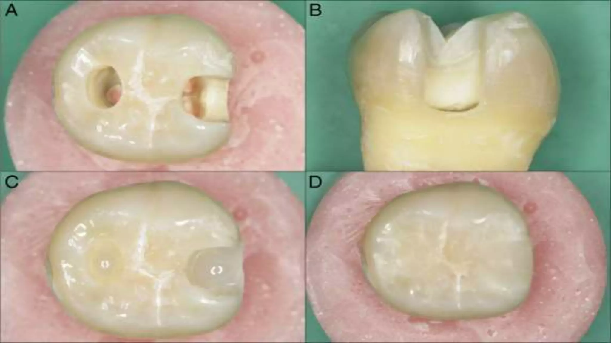 Endodontic Access Cavity Preparation | PPTX
