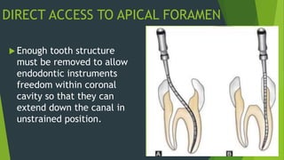 Endodontic Access Cavity Preparation | PPTX