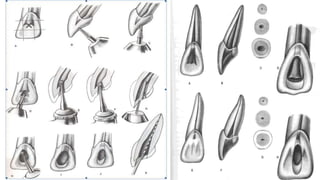 Endodontic Access Cavity Preparation | PPTX