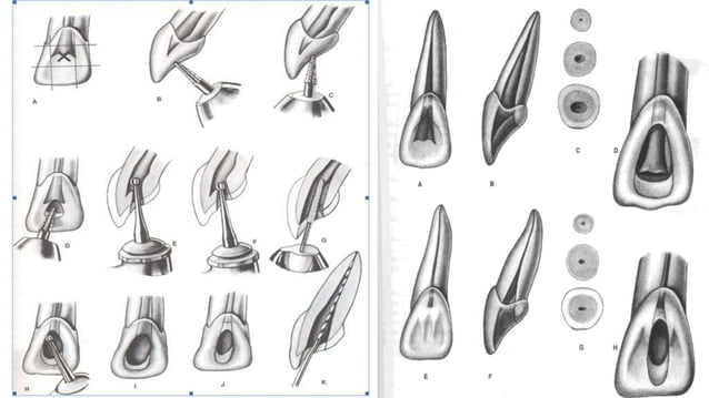 Endodontic Access Cavity Preparation | PPT