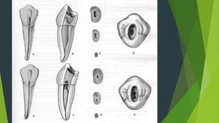 Endodontic Access Cavity Preparation | PPTX