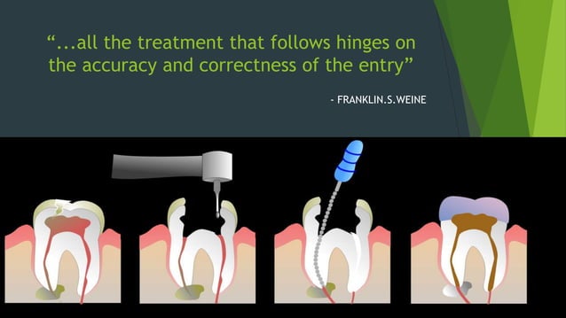 Endodontic Access Cavity Preparation