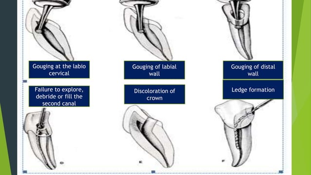 Endodontic Access Cavity Preparation