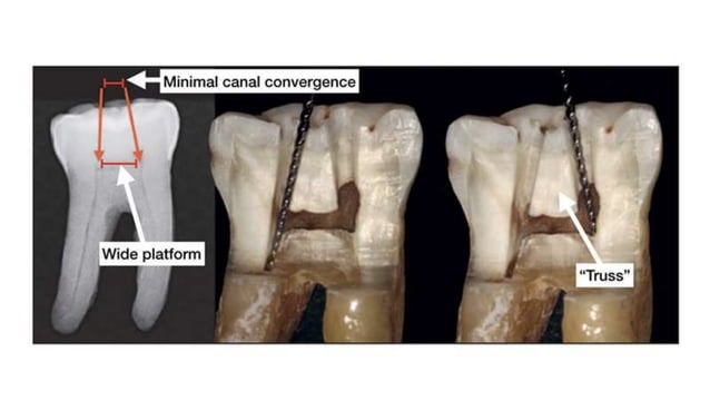 Endodontic Access Cavity Preparation