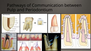 Endodontic and Periodontal Interrelationships.pptx