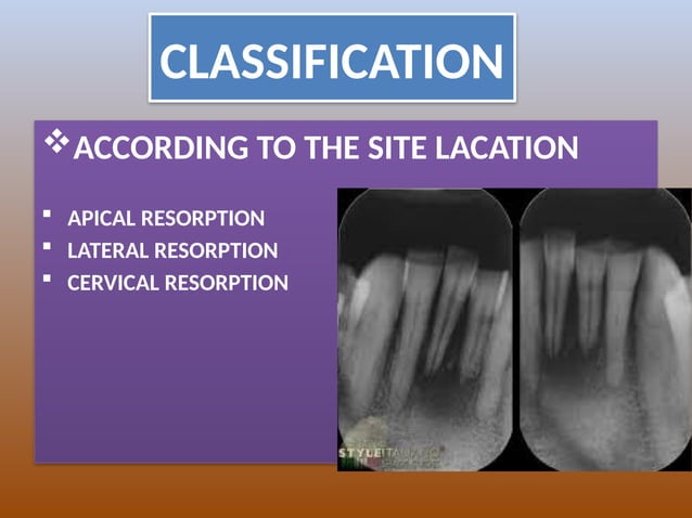 ENDODONTIC ASPECT ROOT RESORPTION dental.pptx