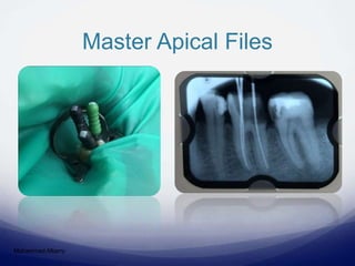 Endodontics Case Presentation | PPT