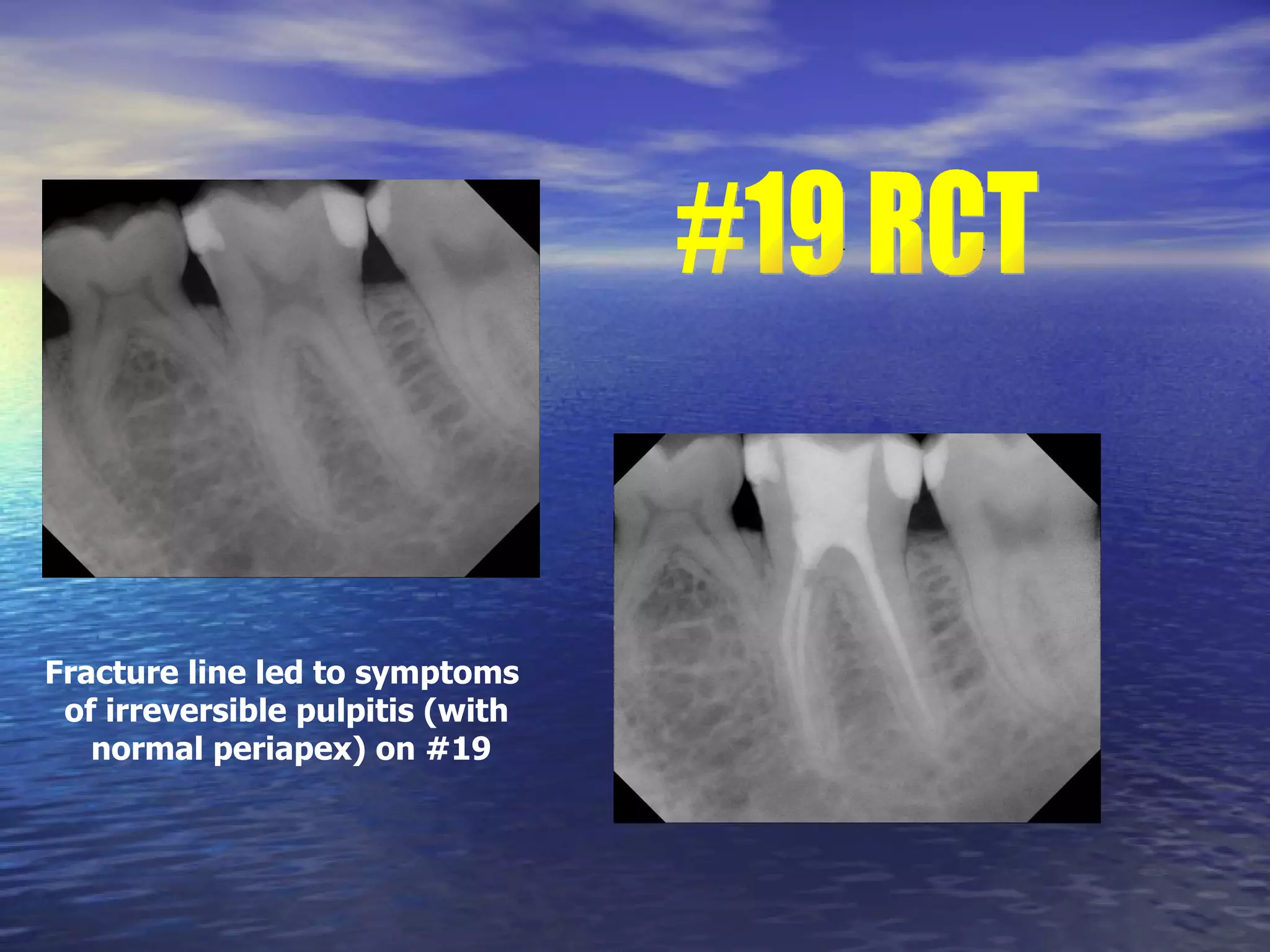 Endodontic Clinical Cases | PPT